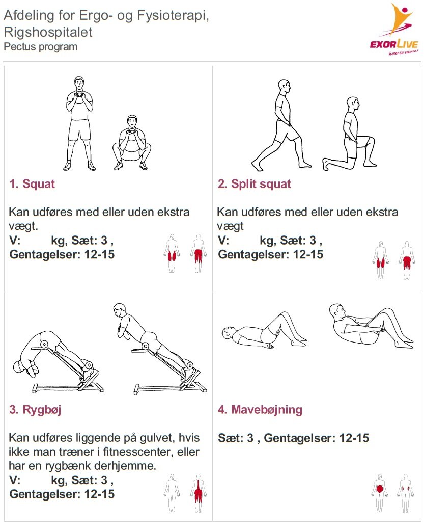 Tragtbryst (pectus excavatum)
